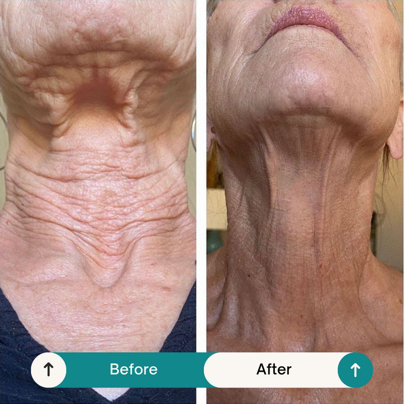 Profosma Jet Plasma – Azura Health and Beauty