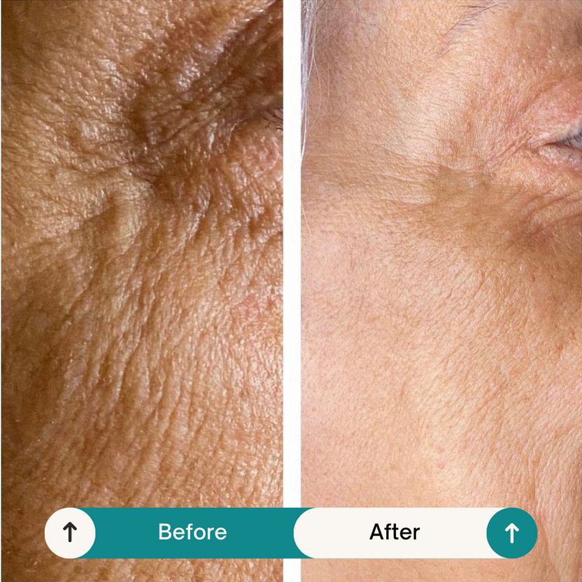 Profosma Jet Plasma – Azura Health and Beauty